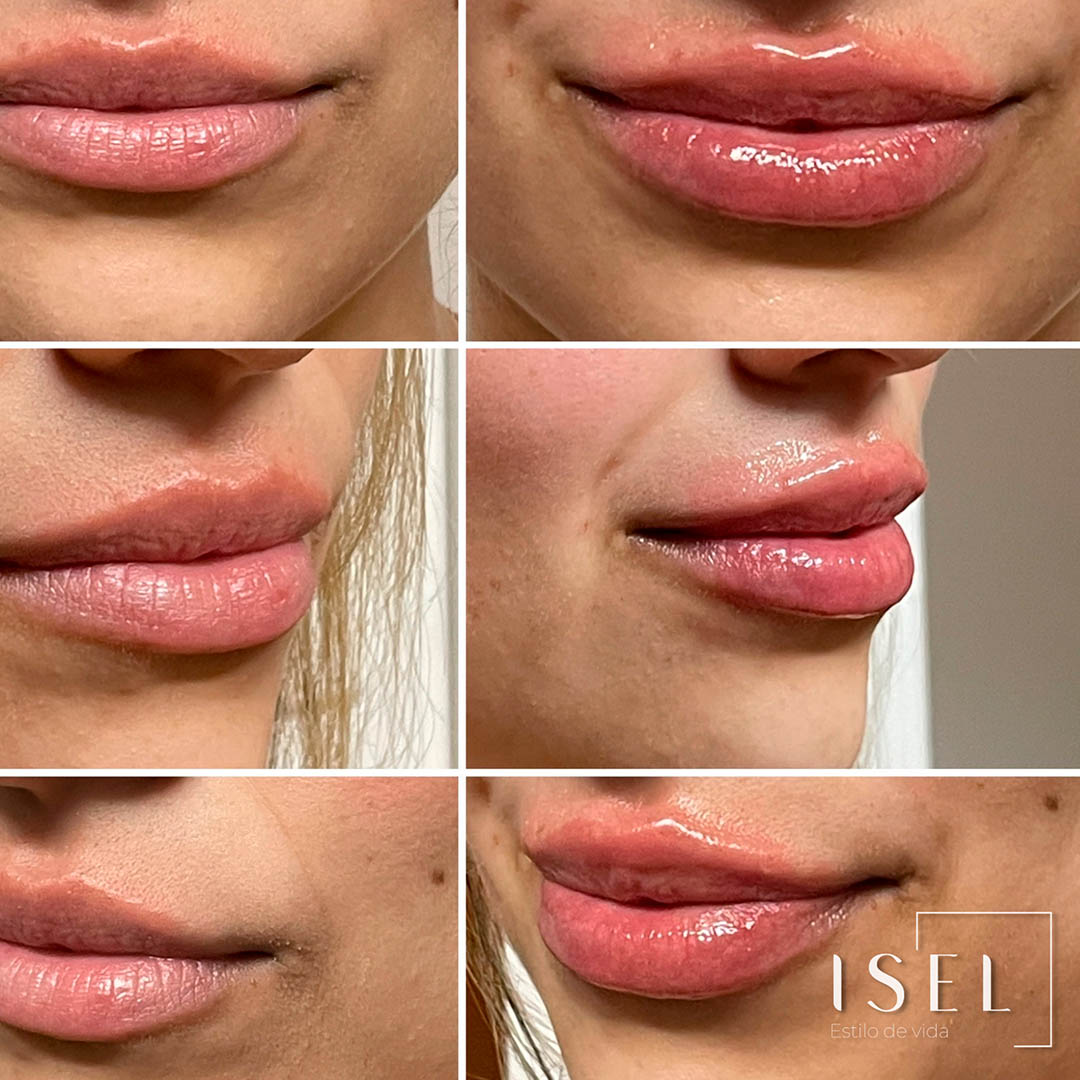 Resultados ISEL Estilo de Vida – ISEL Estilo De Vida